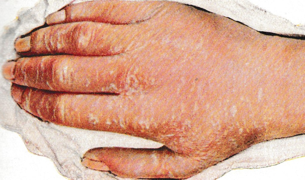 L' ECZEMA est parfois le signe d'un organisme qui élimine mal,